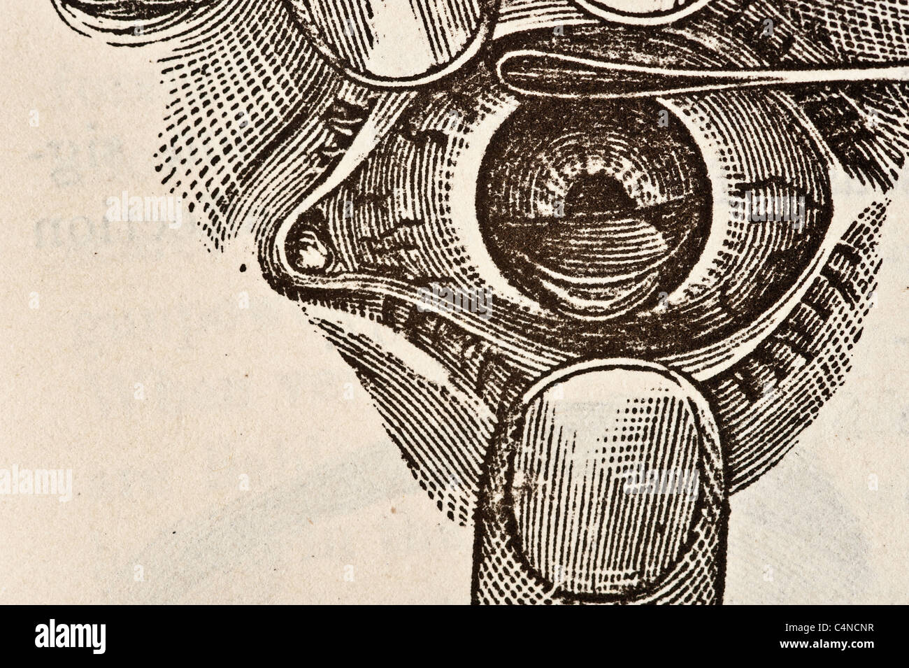 Antique medical illustration of eye disease and Ophthalmologic surgery ...