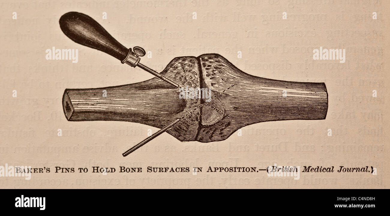 Antique medical illustration of a hip bone, ball & socket Stock Photo ...