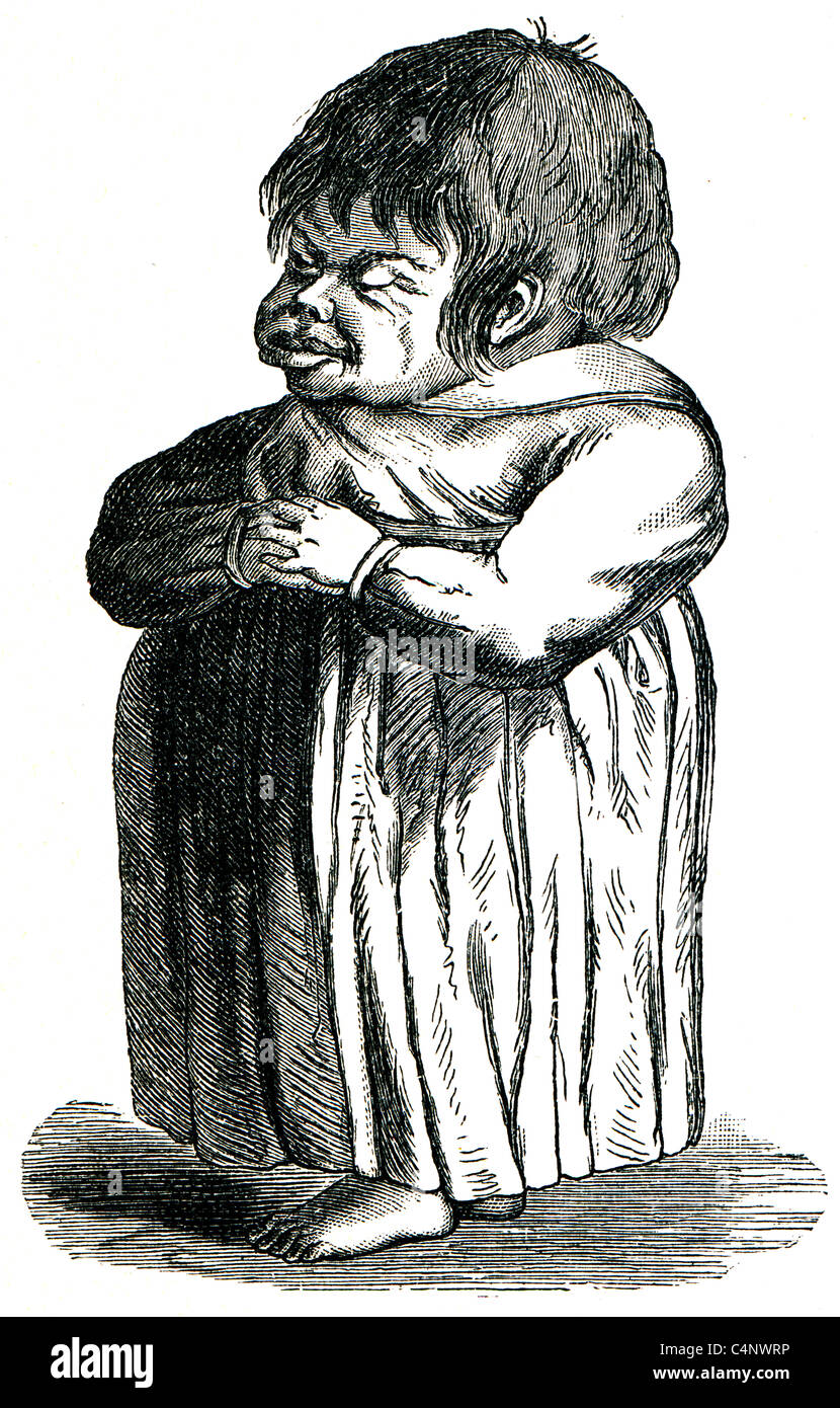 Cretin Aged Cretinism In Infants And Children Is Caused By, 47% OFF