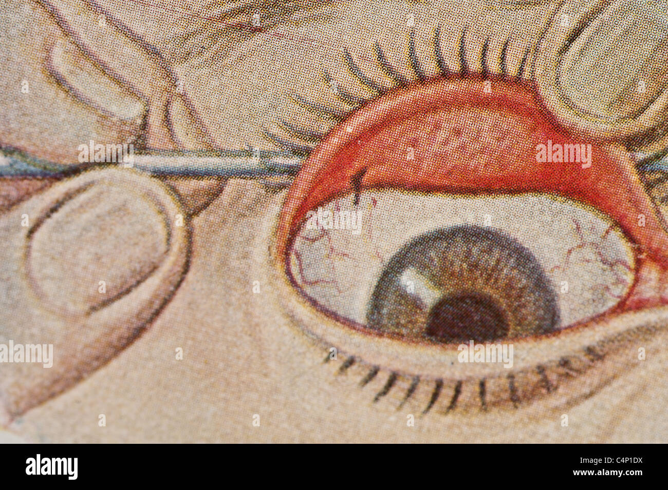 Antique medical illustration of eye disease and Ophthalmology surgery ...