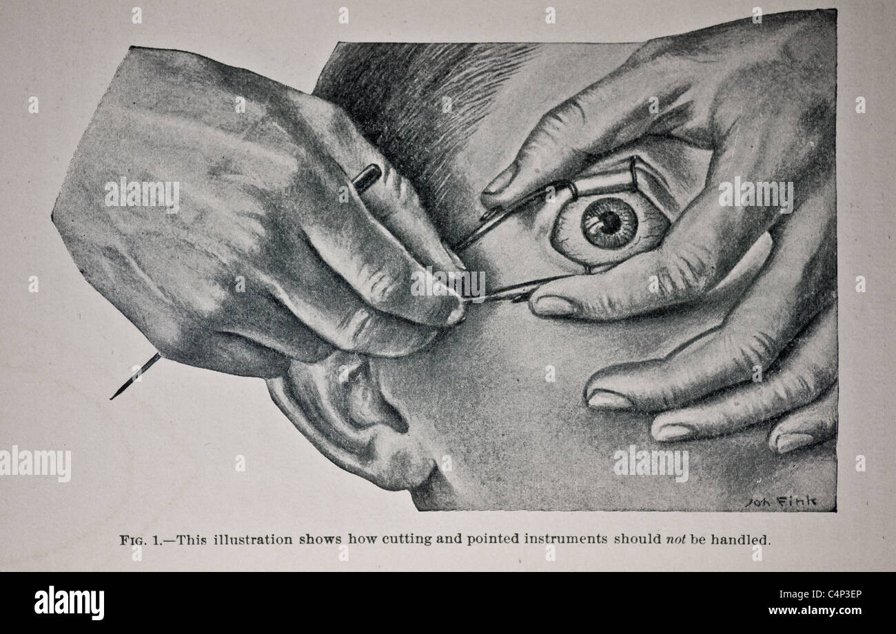 Antique medical illustration of eye disease and Ophthalmologic surgery ...