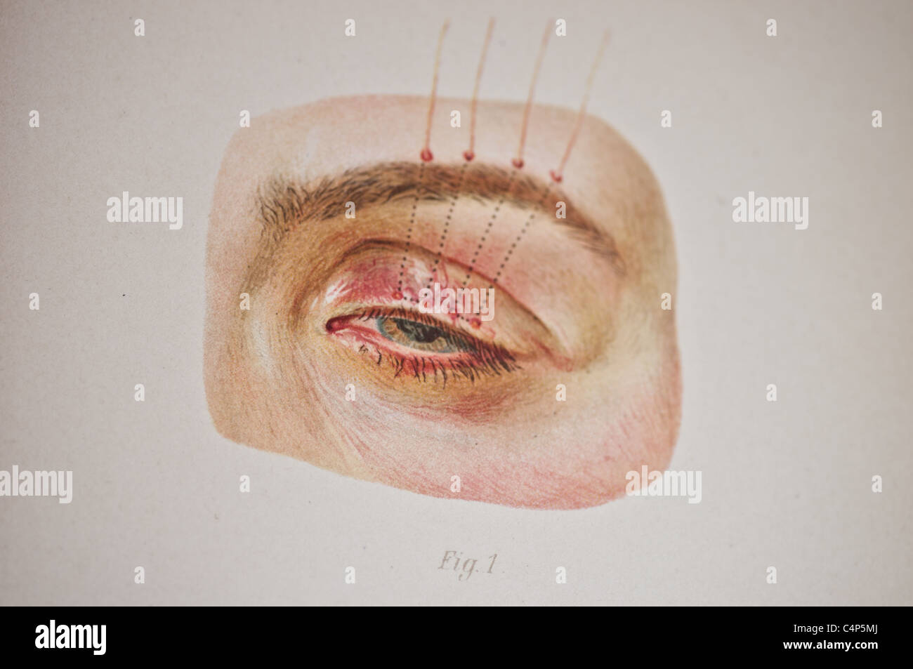 Antique medical illustration of eye disease and Ophthalmologic surgery ...