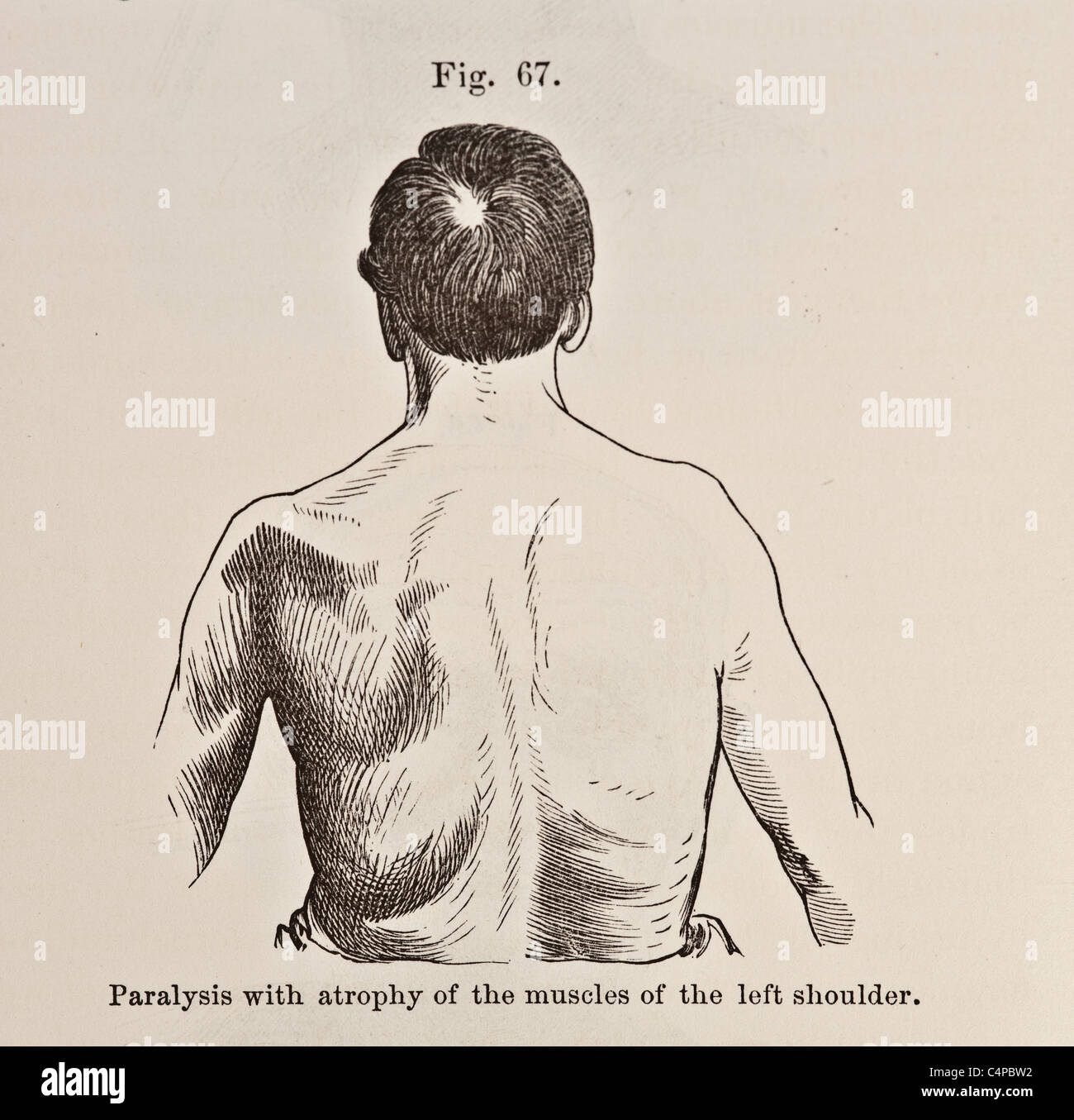 Illustration of Paralysis with Atrophy of the Muscles of the Left ...