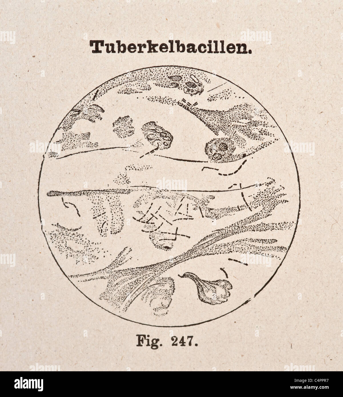 Vintage antique medical illustration of Tuberculosis Bacterium circa ...