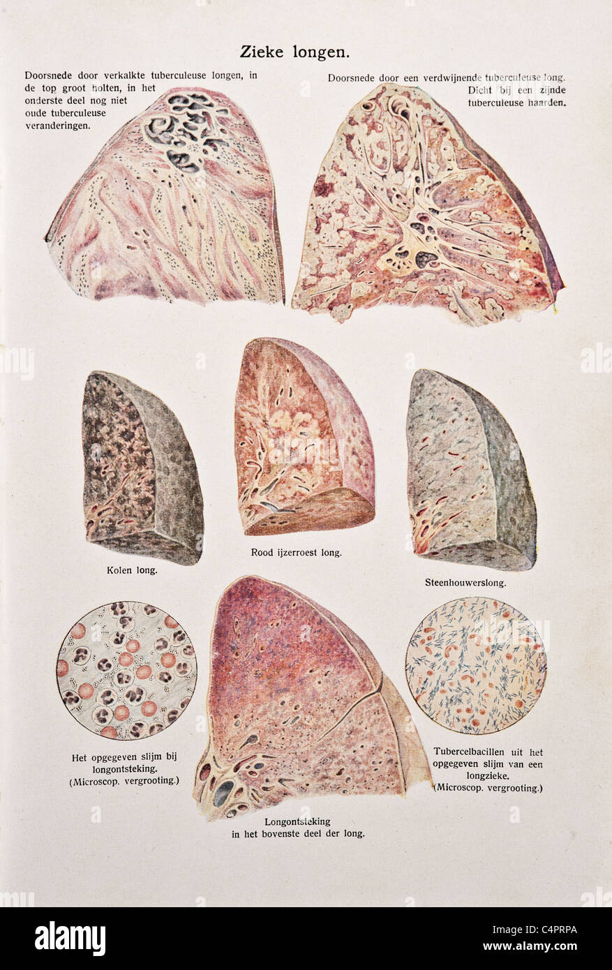 Antique illustration of diseased lung Stock Photo - Alamy