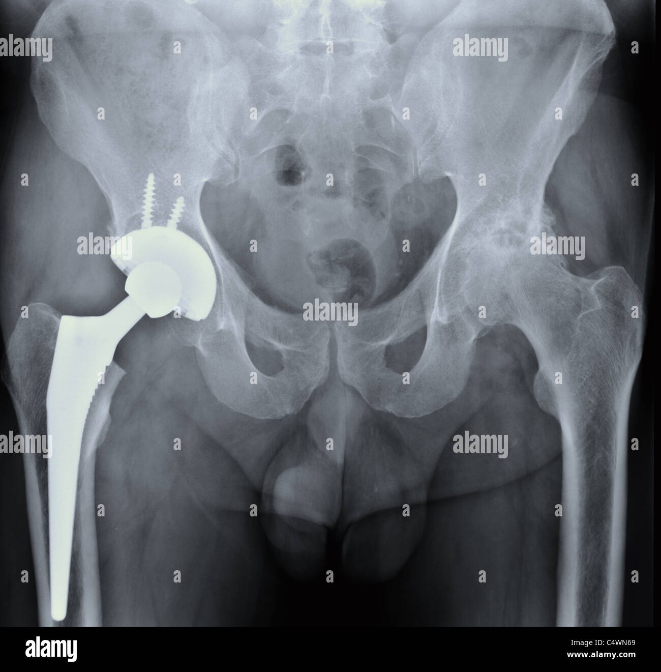 X-ray of pelvis Stock Photo - Alamy