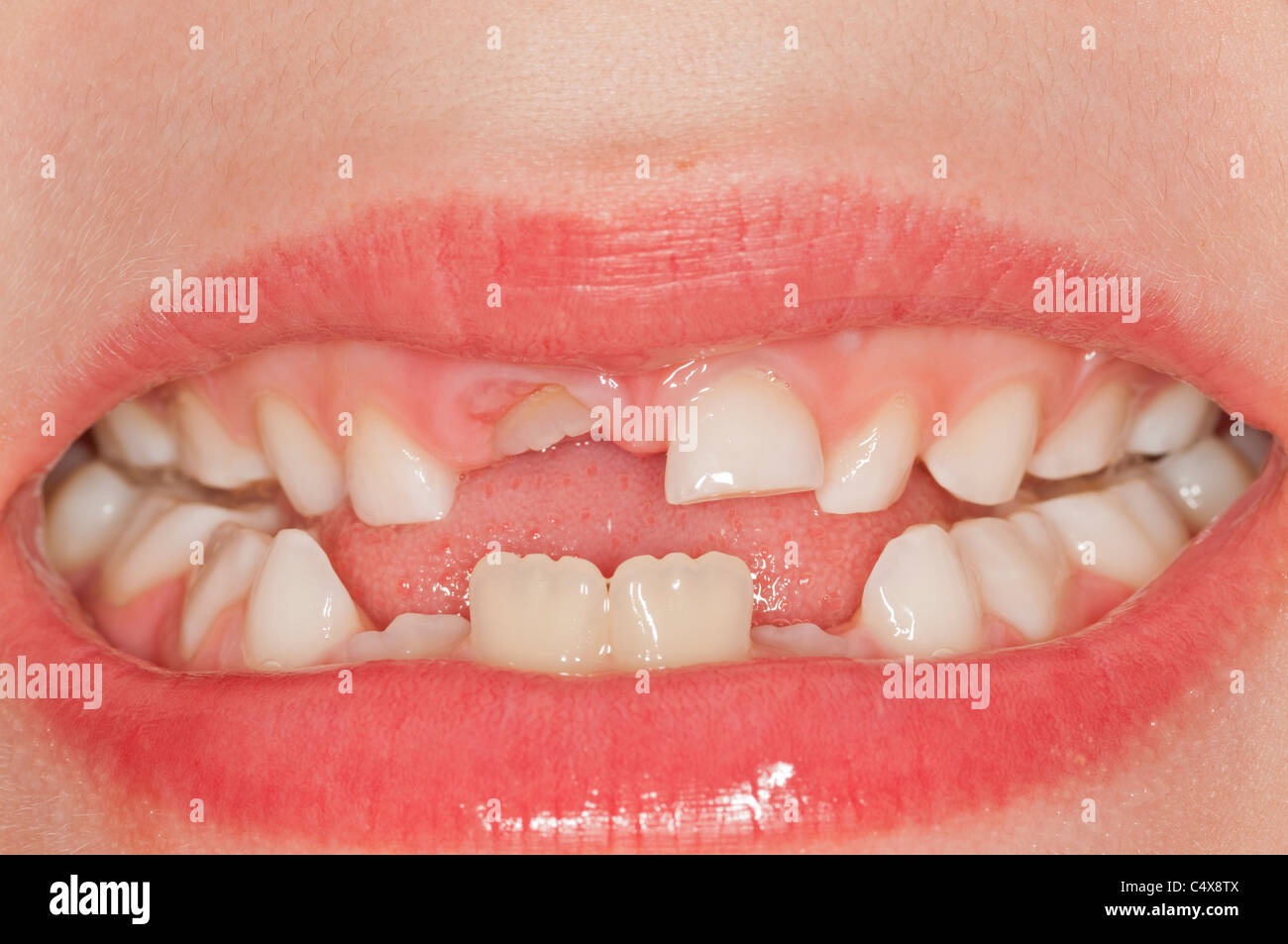 A close up of a seven year old childs mouth with three new teeth ...