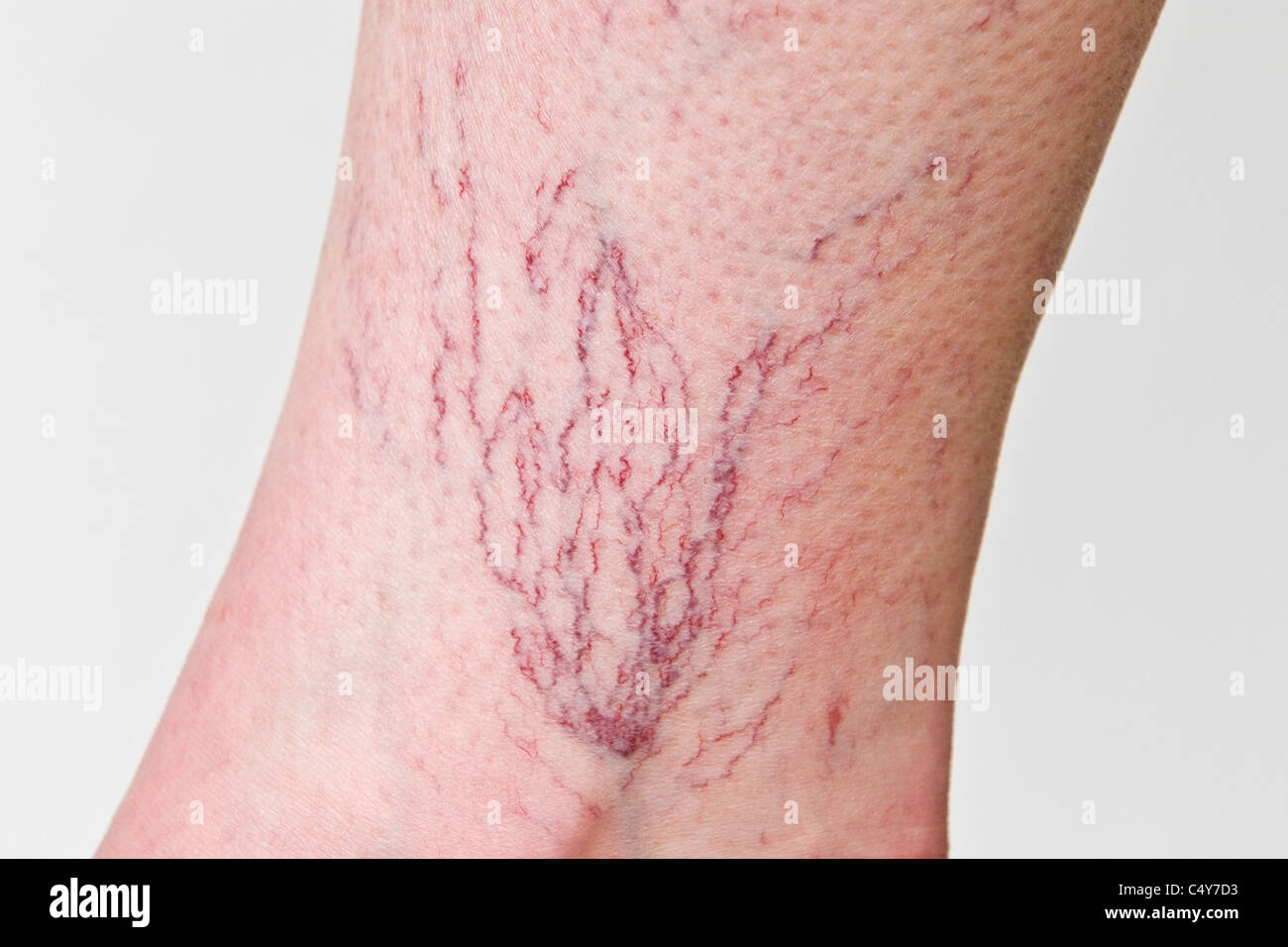 Capillaries and veins hi-res stock photography and images - Alamy