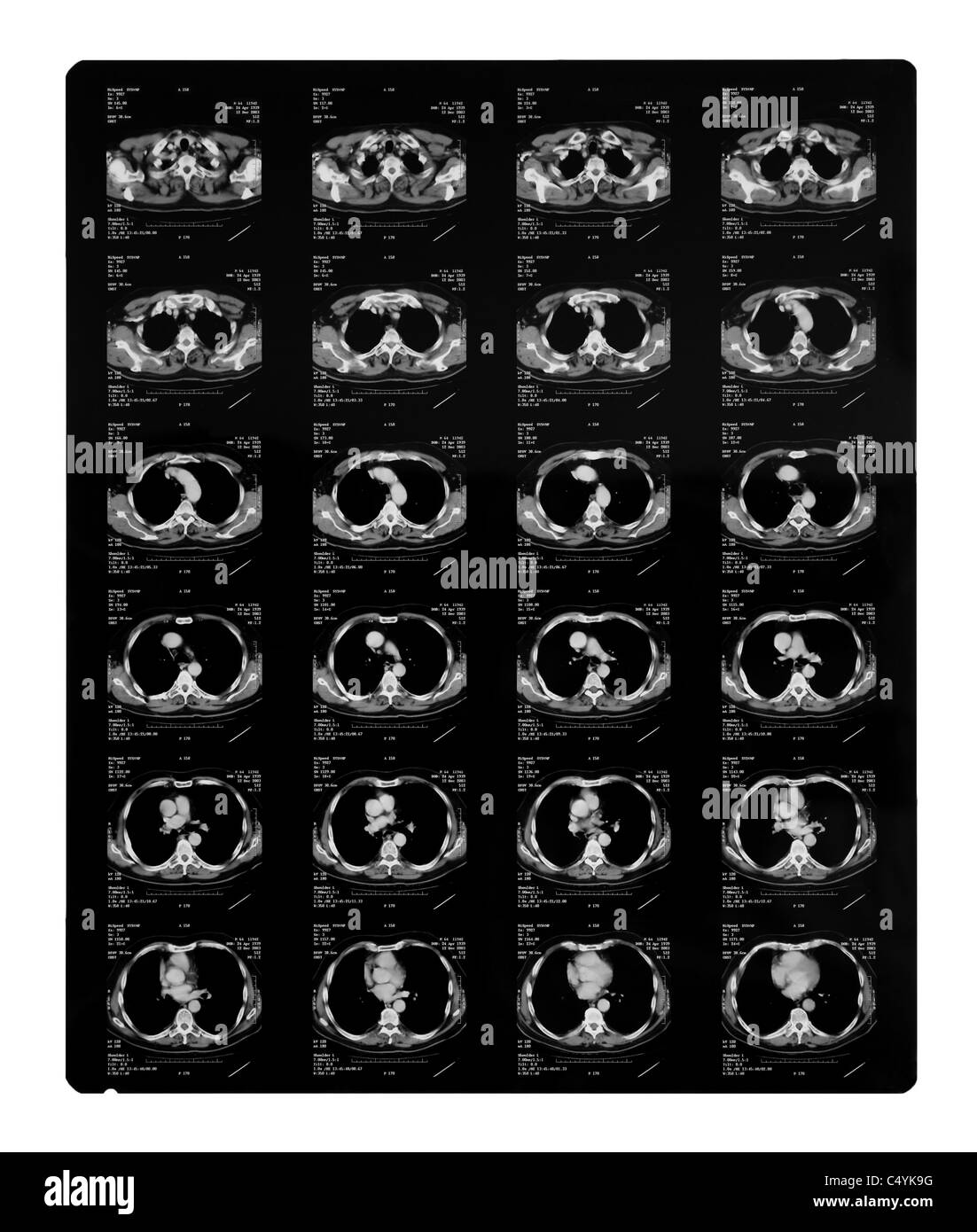 Cancer magnetic resonance imaging mri Cut Out Stock Images & Pictures ...