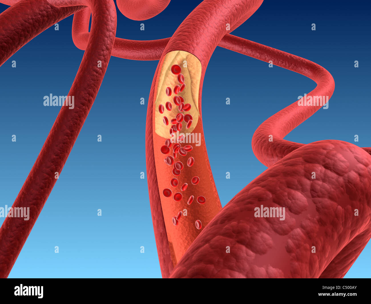 Artery with arteriosclerosis Stock Photo - Alamy