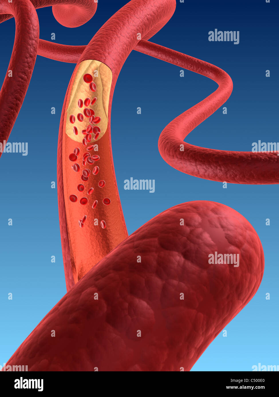Artery with arteriosclerosis Stock Photo - Alamy