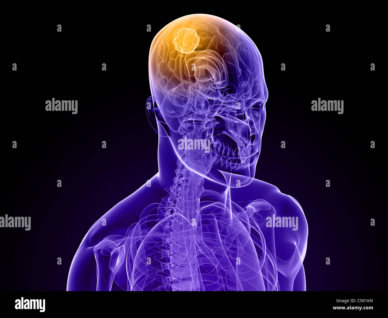 Brain tumor scan hi-res stock photography and images - Alamy