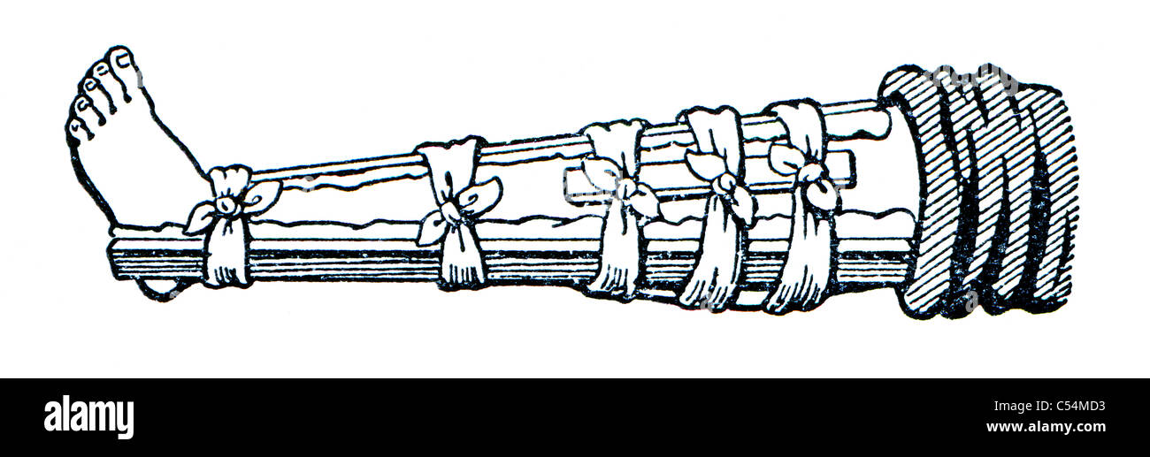 Rules for splinting a broken leg Stock Photo - Alamy