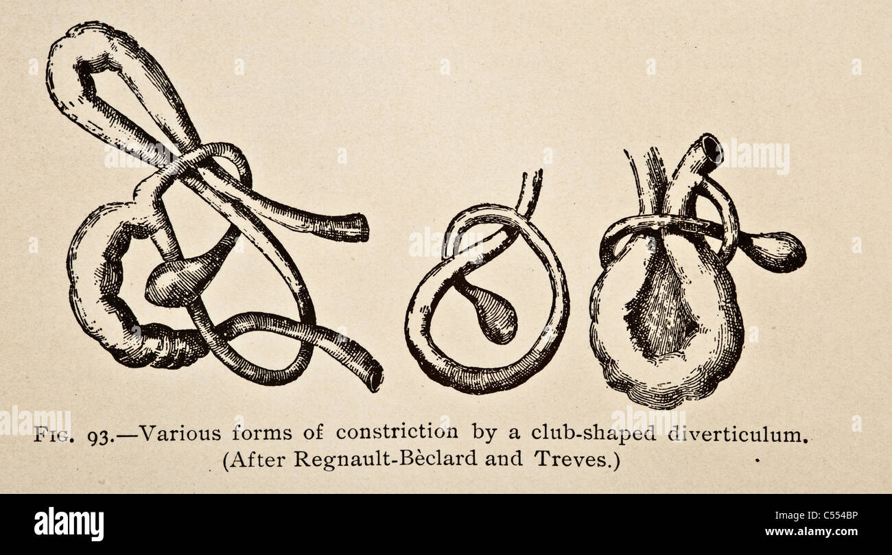 Antique medical illustration of various forms of constriction formed by ...