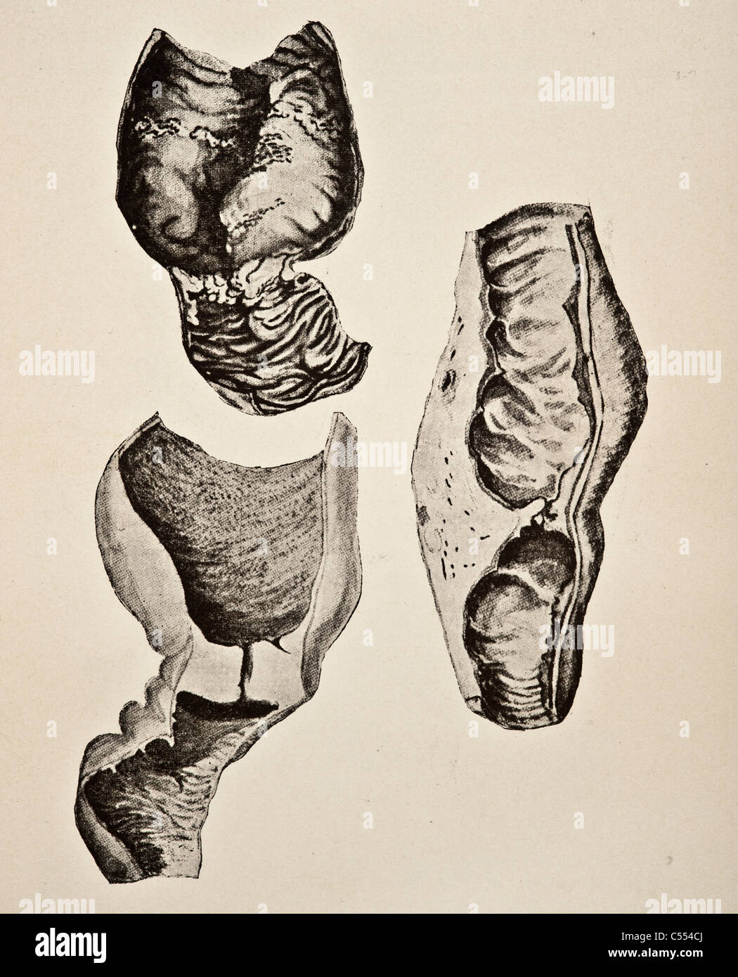 Small bowel obstruction hi-res stock photography and images - Alamy