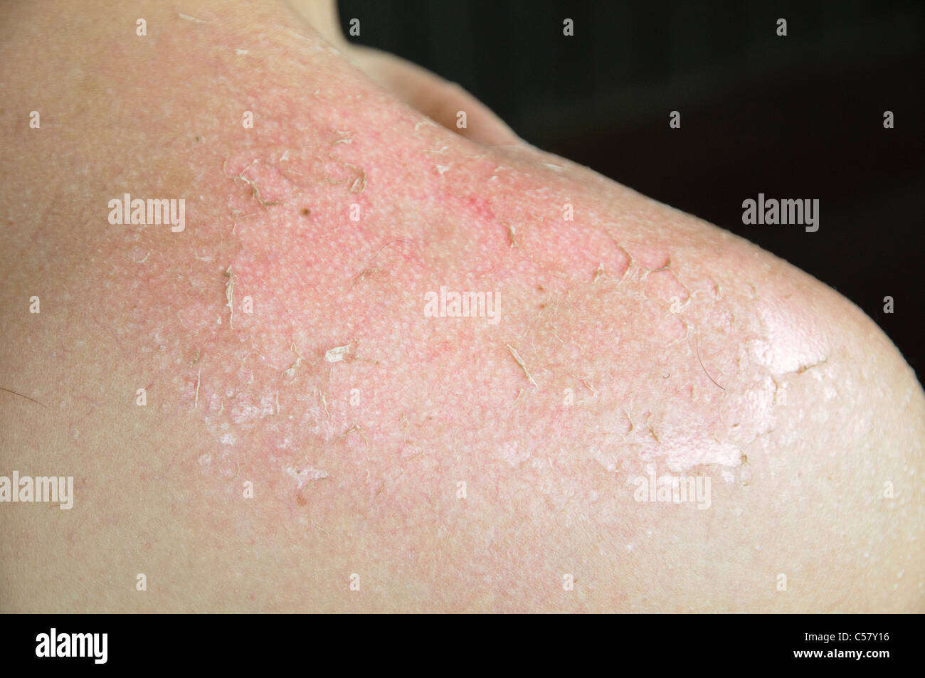 Skin problems hi-res stock photography and images - Alamy