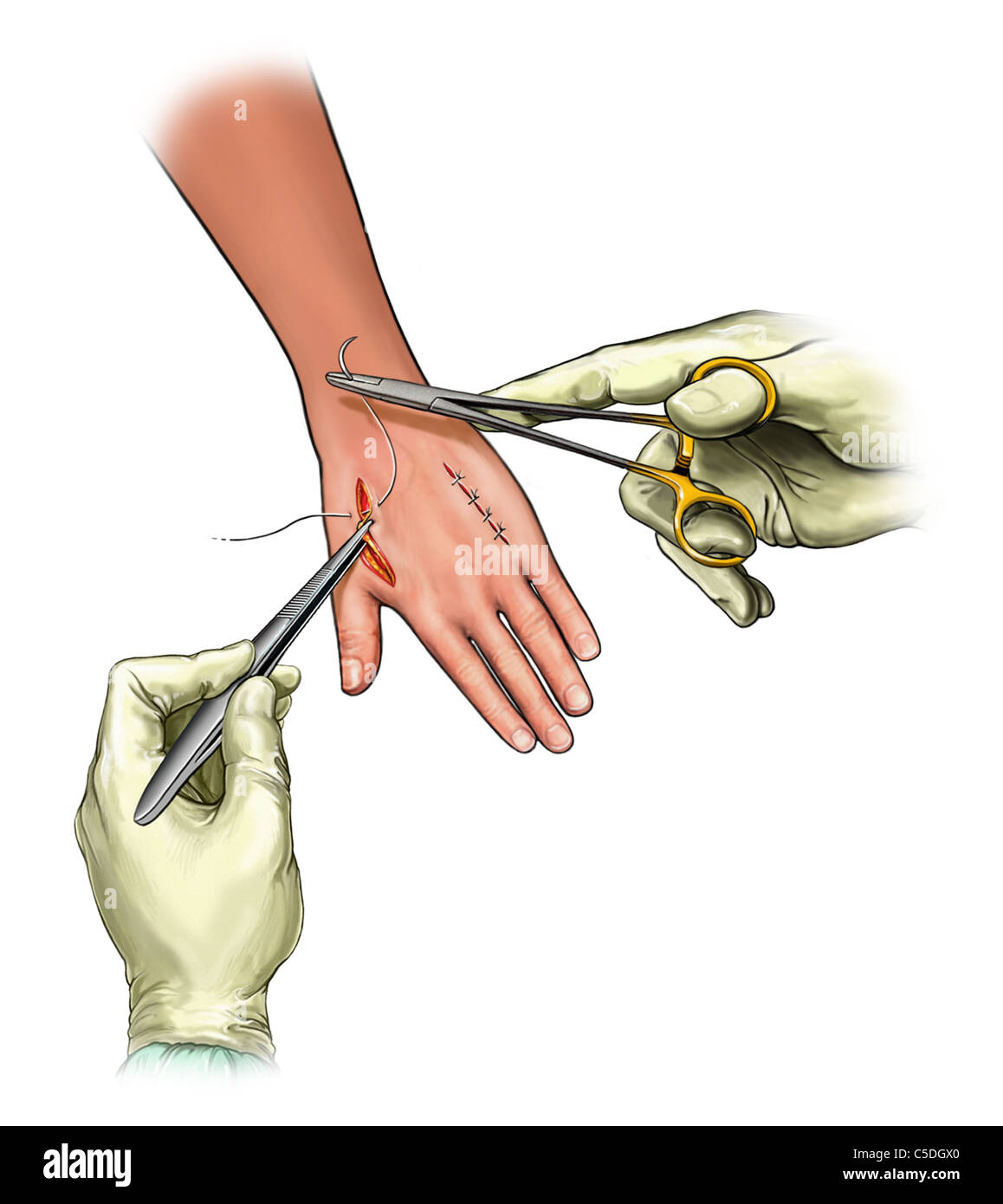 Fasciotomy hi-res stock photography and images - Alamy