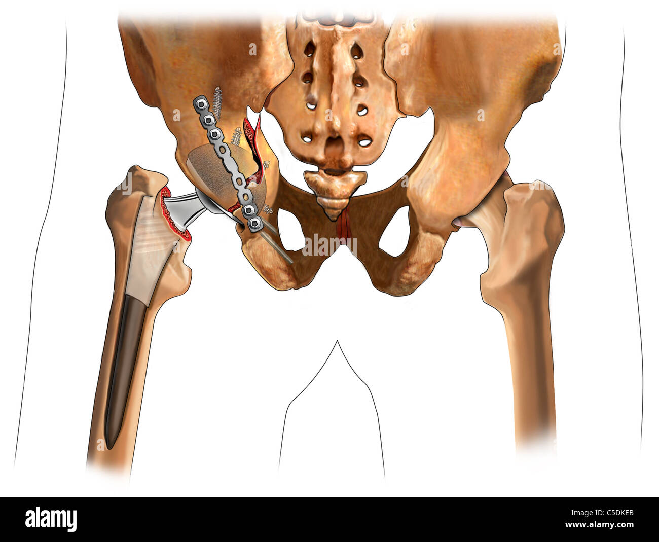 Posterior acetabular fracture hi-res stock photography and images - Alamy