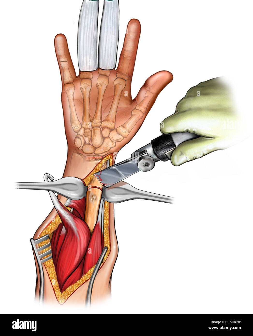 Osteotomy High Resolution Stock Photography and Images - Alamy