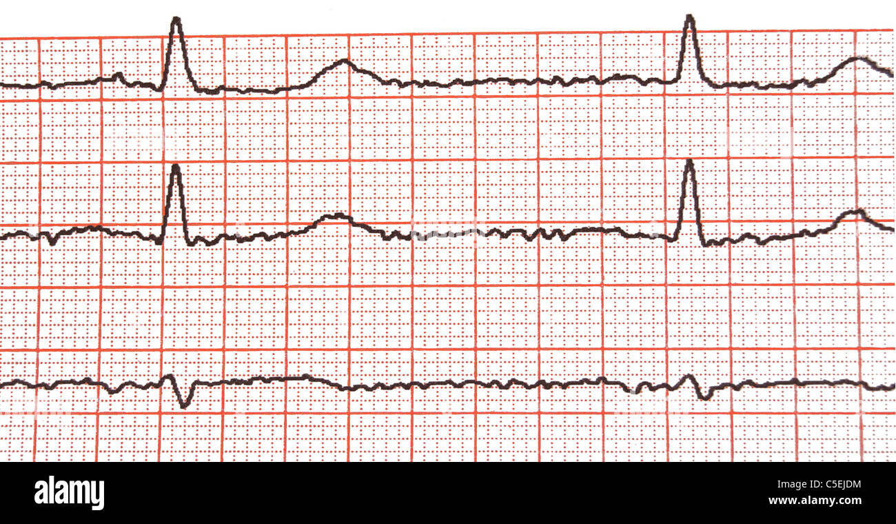 Hospital chart heart monitor hi-res stock photography and images - Alamy