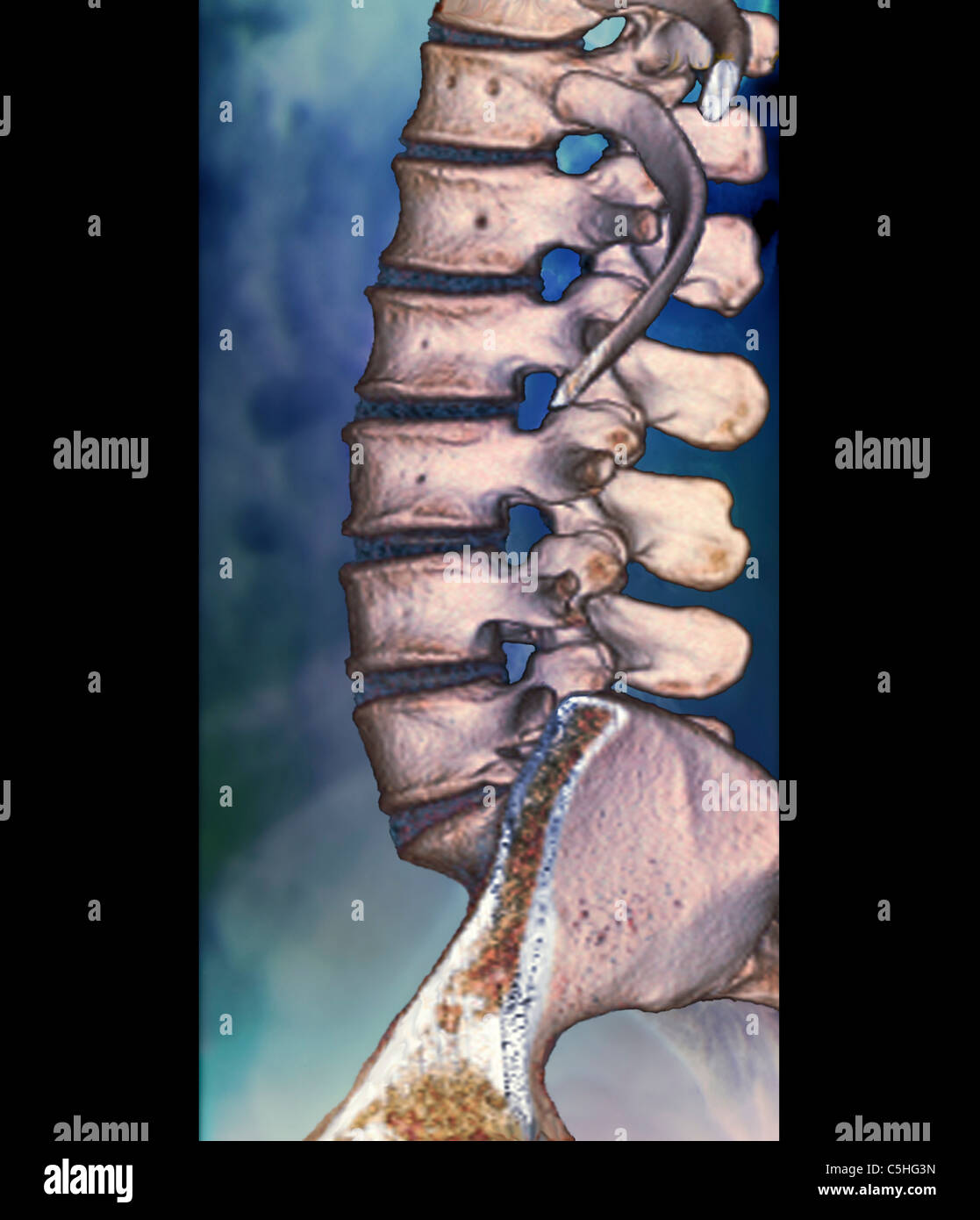 Ct Spine Stock Photos & Ct Spine Stock Images - Alamy