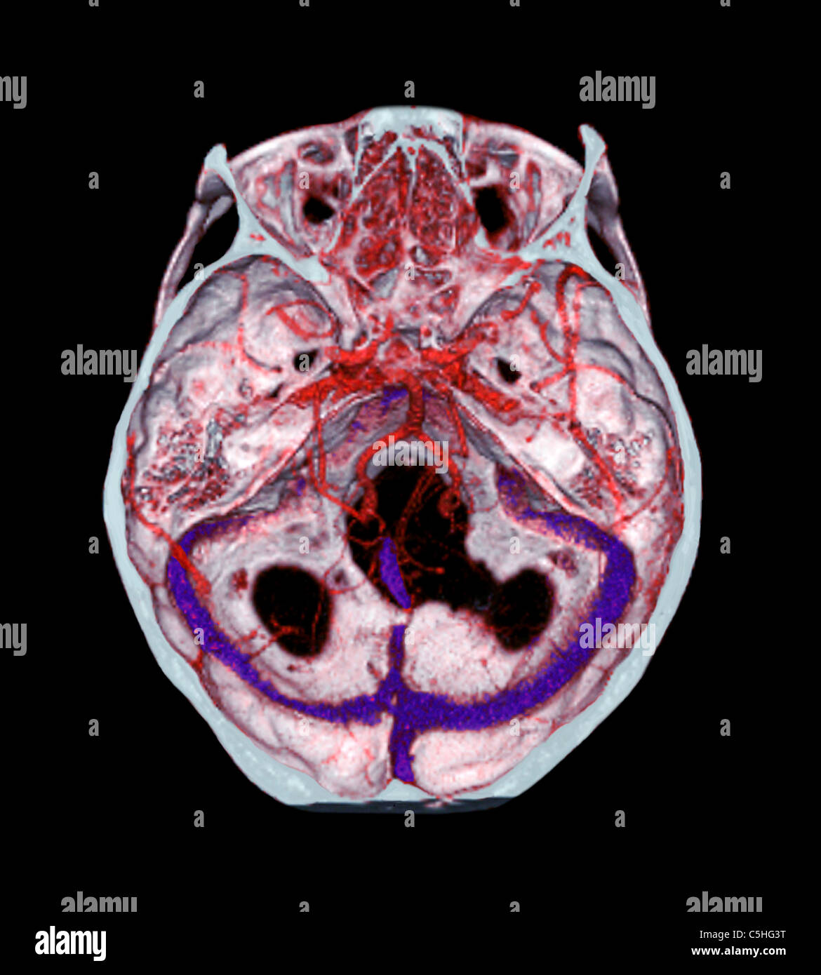 Arteries of the brain, 3D CT scan Stock Photo - Alamy