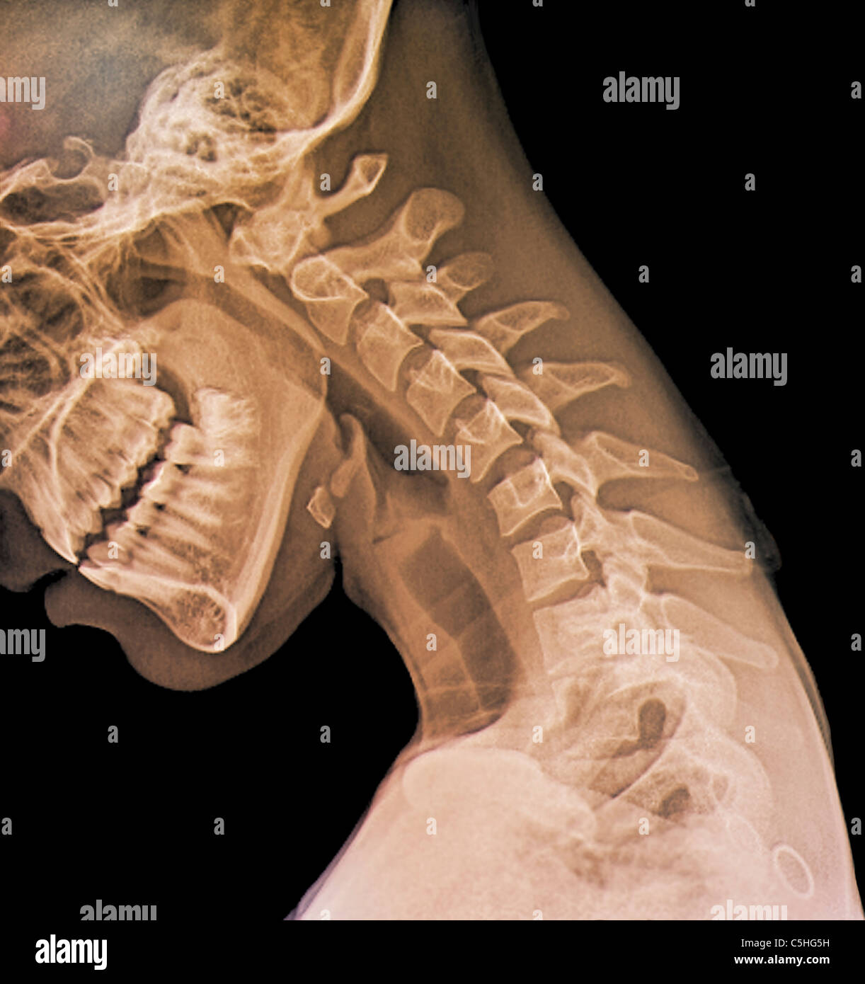 Normal flexed neck, X-ray Stock Photo - Alamy