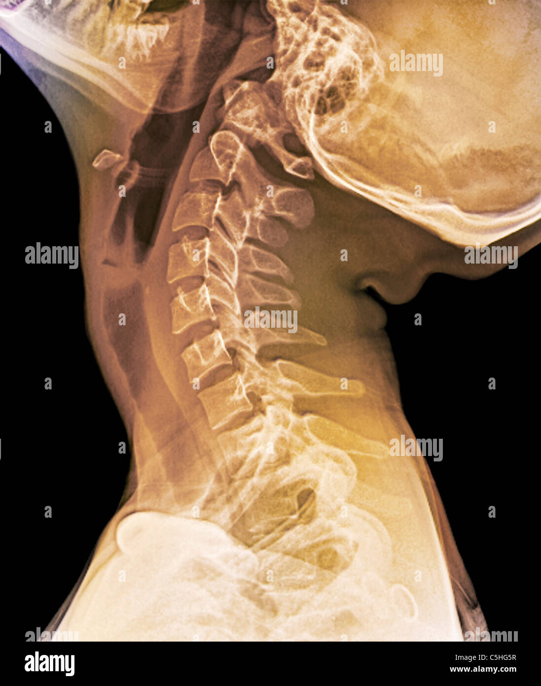 Normal extended neck, X-ray Stock Photo - Alamy