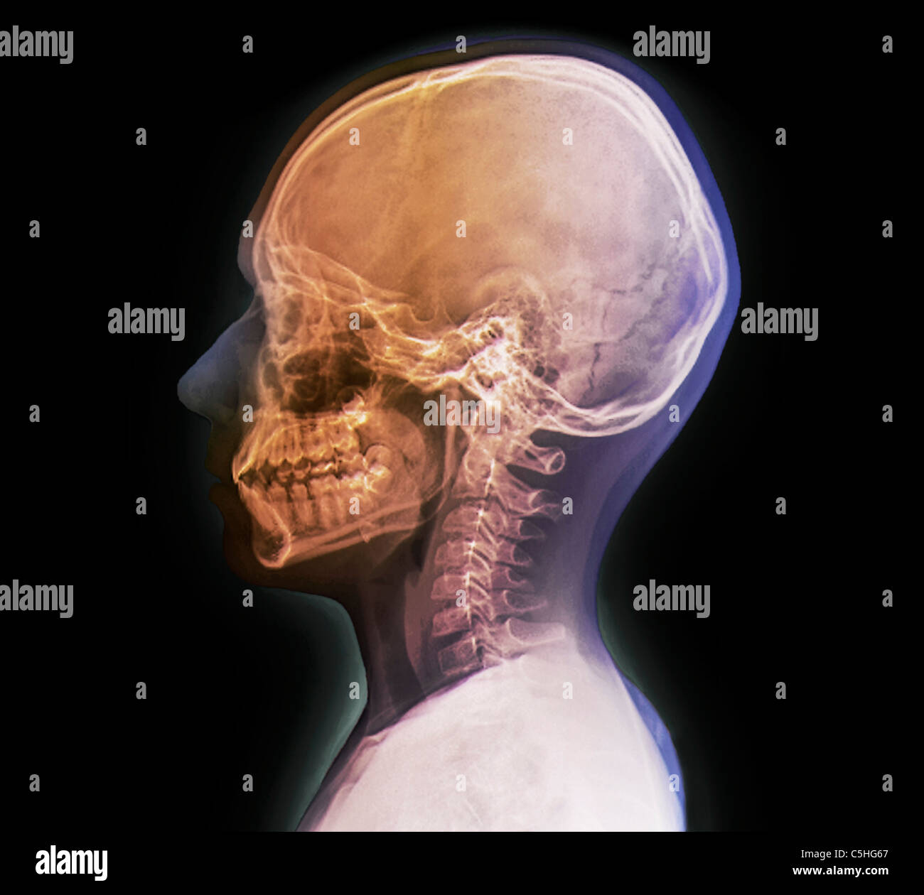 Normal Neck X Ray High Resolution Stock Photography and Images - Alamy