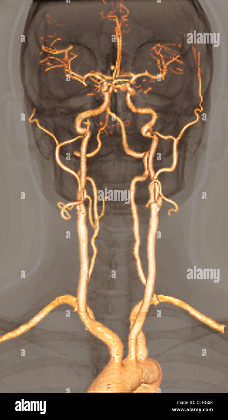 Normal arteries, 3D CT scan Stock Photo - Alamy Normal arteries, 3D CT scan Stock Photo - Alamy
