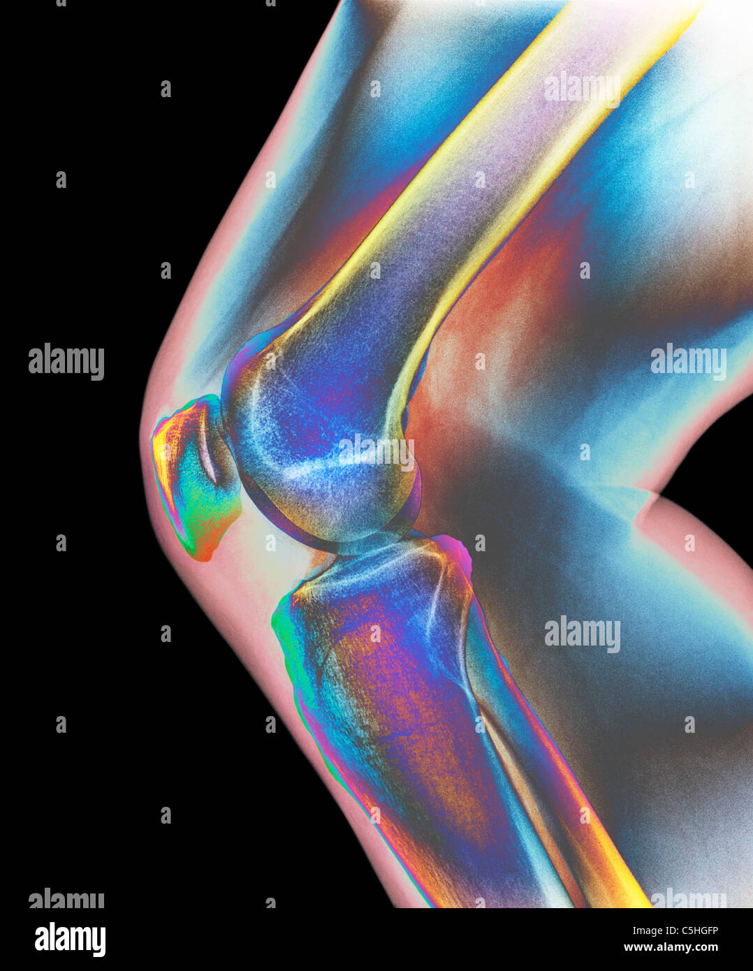 Normal Knee X Ray High Resolution Stock Photography and Images - Alamy