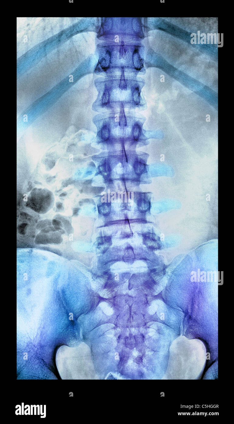 Normal spine ct scan hi-res stock photography and images - Alamy