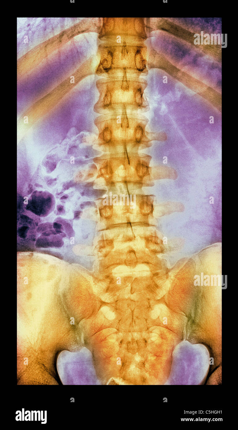 Normal spine ct scan hi-res stock photography and images - Alamy