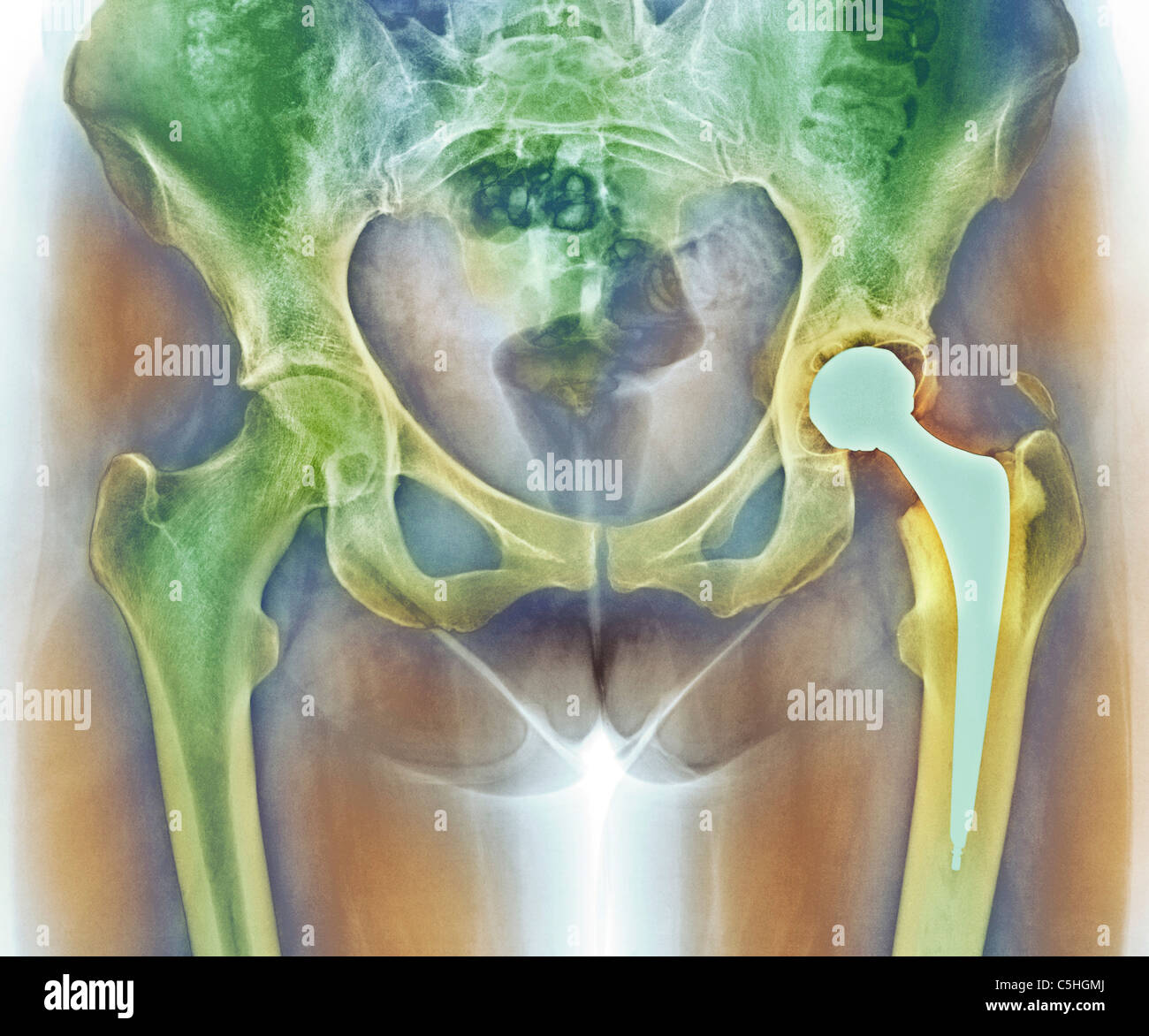 Loosened hip replacement, X-ray Stock Photo - Alamy