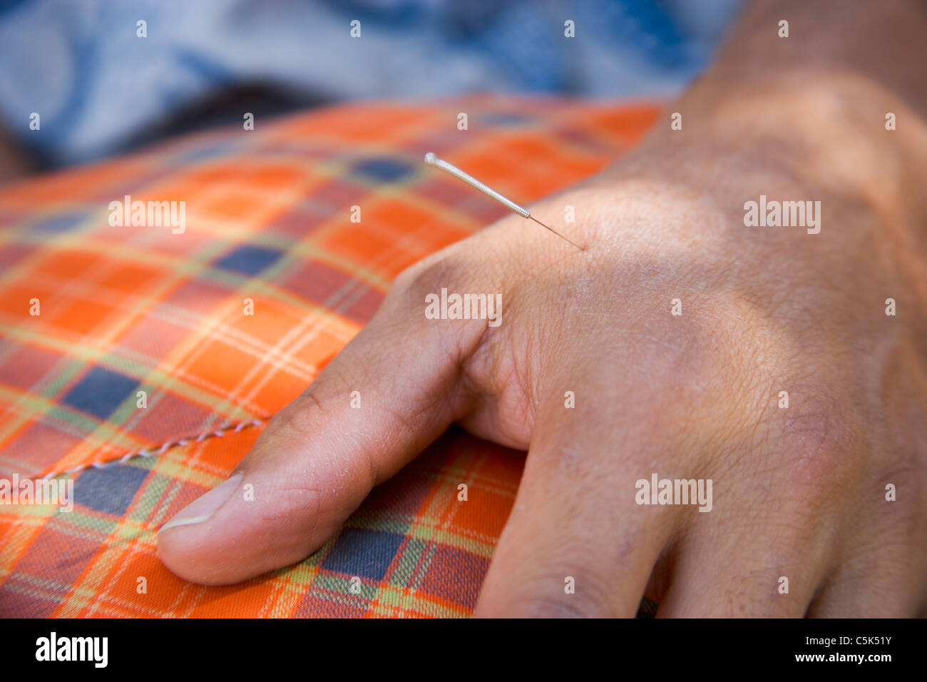 Male hand treated with acupuncture Stock Photo - Alamy