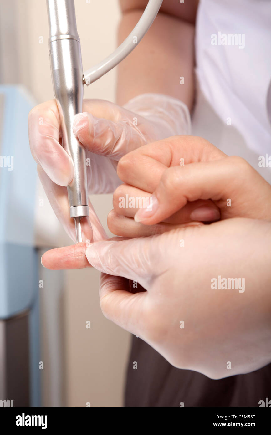 Wart hand hi-res stock photography and images - Alamy