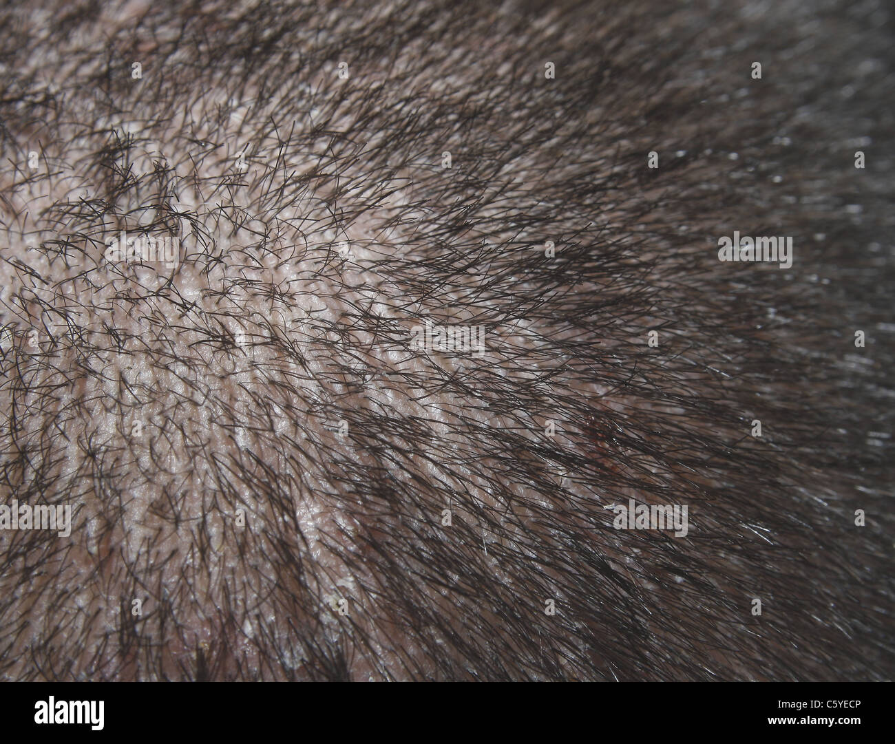 Minor Psoriasis Scalp