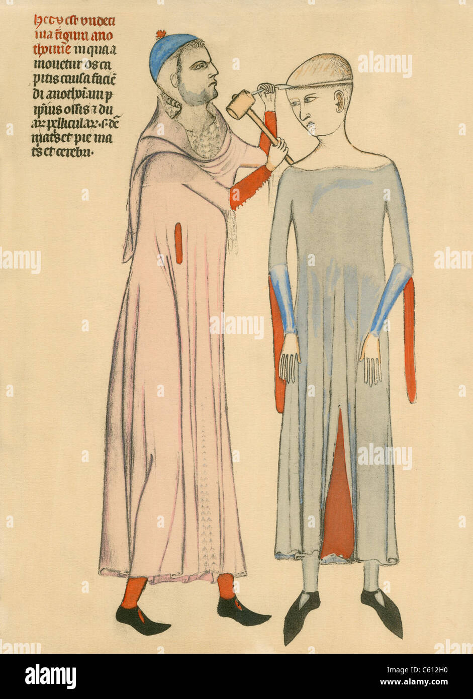 Medieval doctor cutting open a patient's skull with a hammer and blade ...