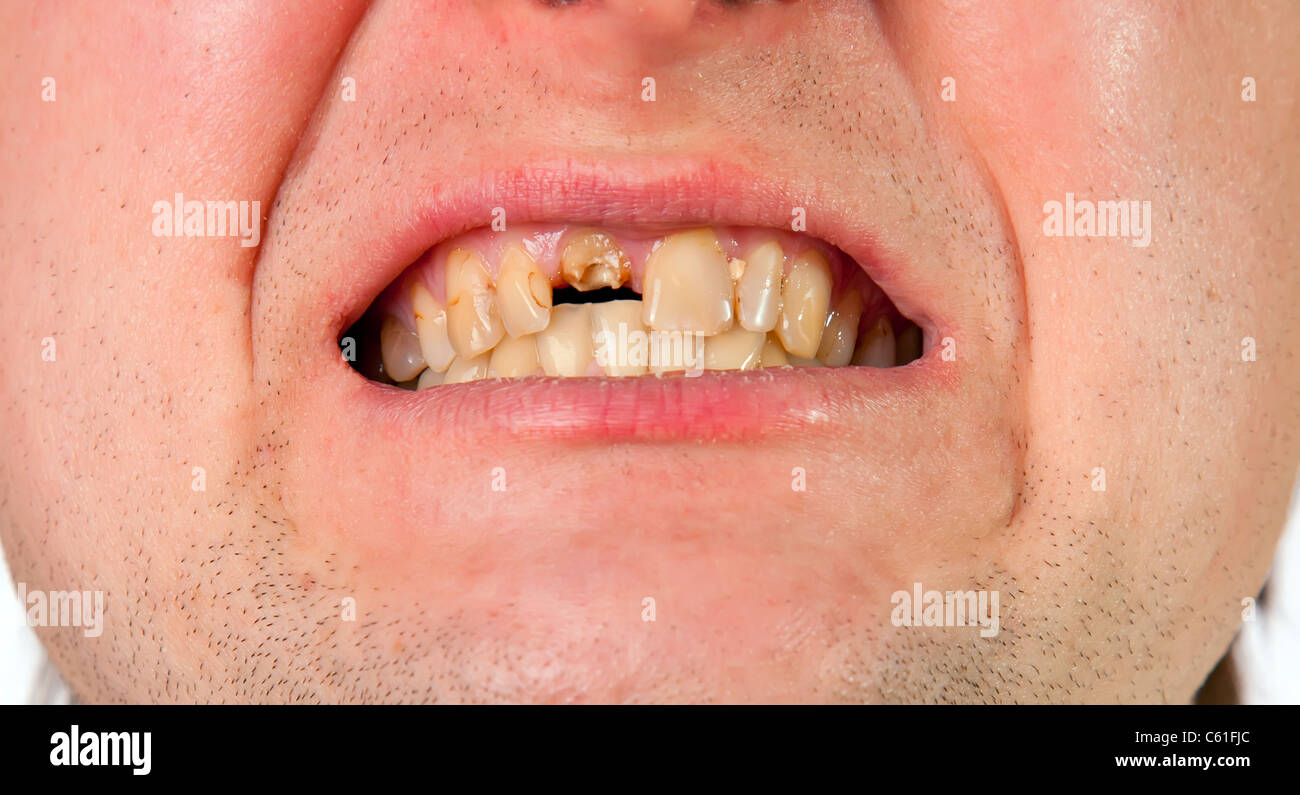 Broken tooth hi-res stock photography and images - Alamy