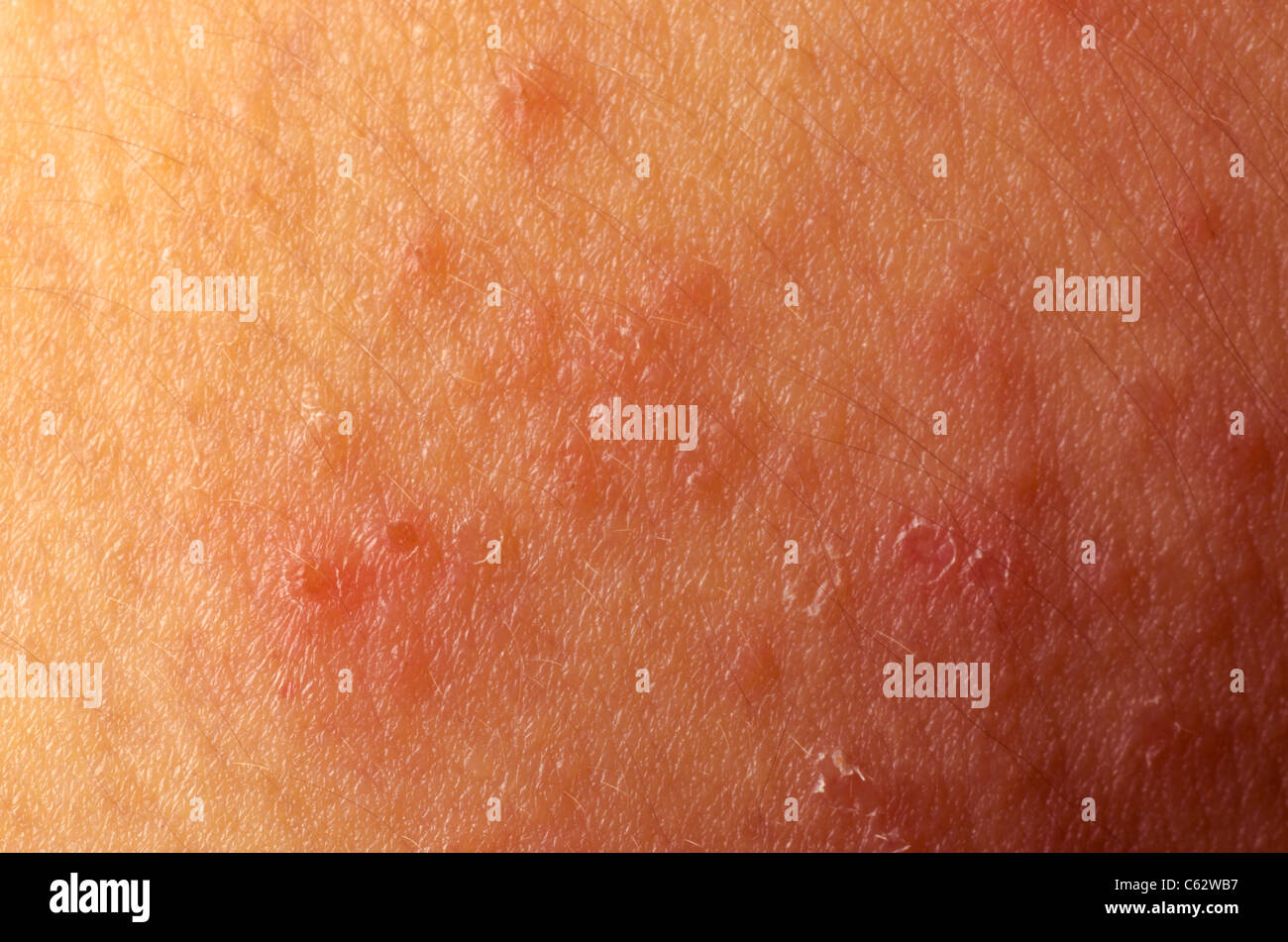eczema atopic dermatitis symptom skin detail texture Stock Photo - Alamy