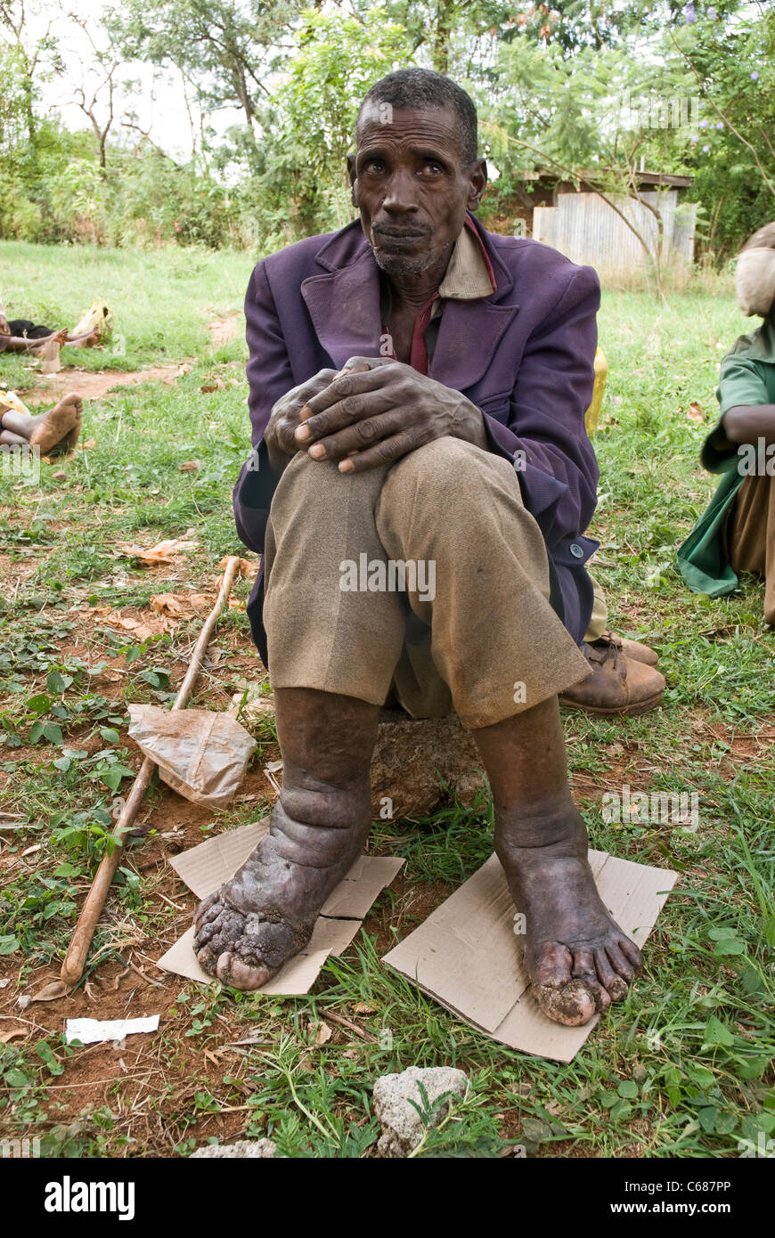 Patient with podoconiosis at the Mossy Foot Outreach Clinic in Sodo ...
