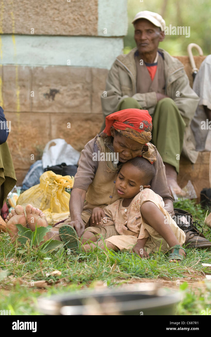 Patient with podoconiosis at the Mossy Foot Outreach Clinic in Sodo ...