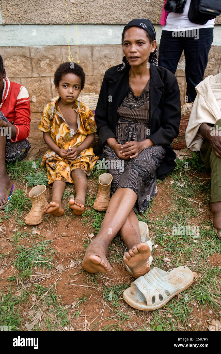 Patient with podoconiosis at the Mossy Foot Outreach Clinic in Sodo ...