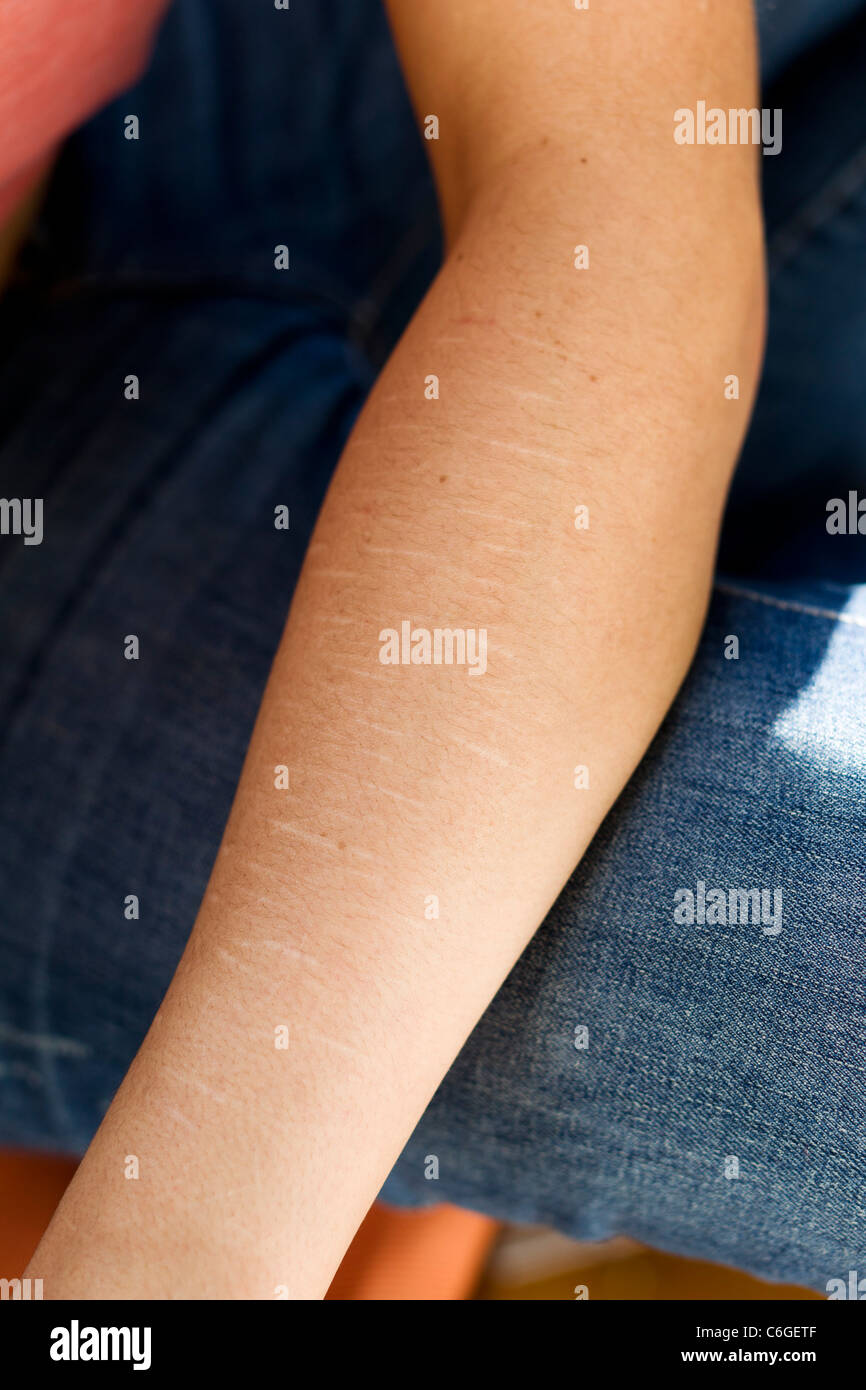 Self harmed arm Stock Photo - Alamy