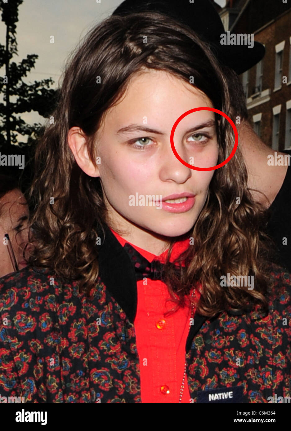 Sporting a black eye hi-res stock photography and images - Alamy