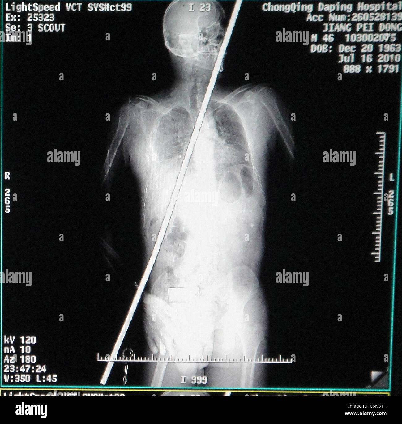 HUMAN KEBAB' MAN SPIKED BY STEEL BAR Forty six year-old carpenter, Mr ...