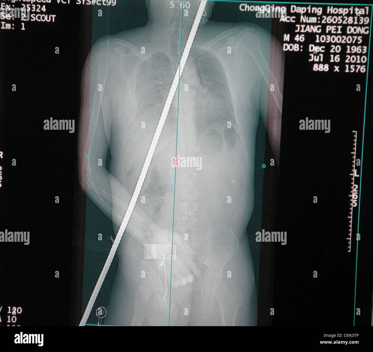 HUMAN KEBAB' MAN SPIKED BY STEEL BAR Forty six year-old carpenter, Mr ...