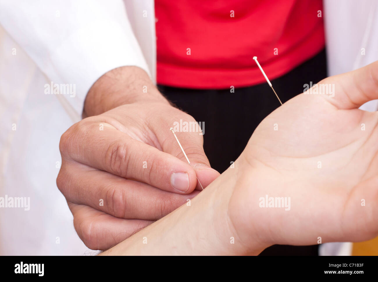 Acupuncture being performed Stock Photo - Alamy