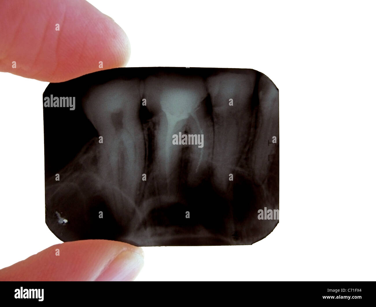 roentgenogram of teeth Stock Photo - Alamy
