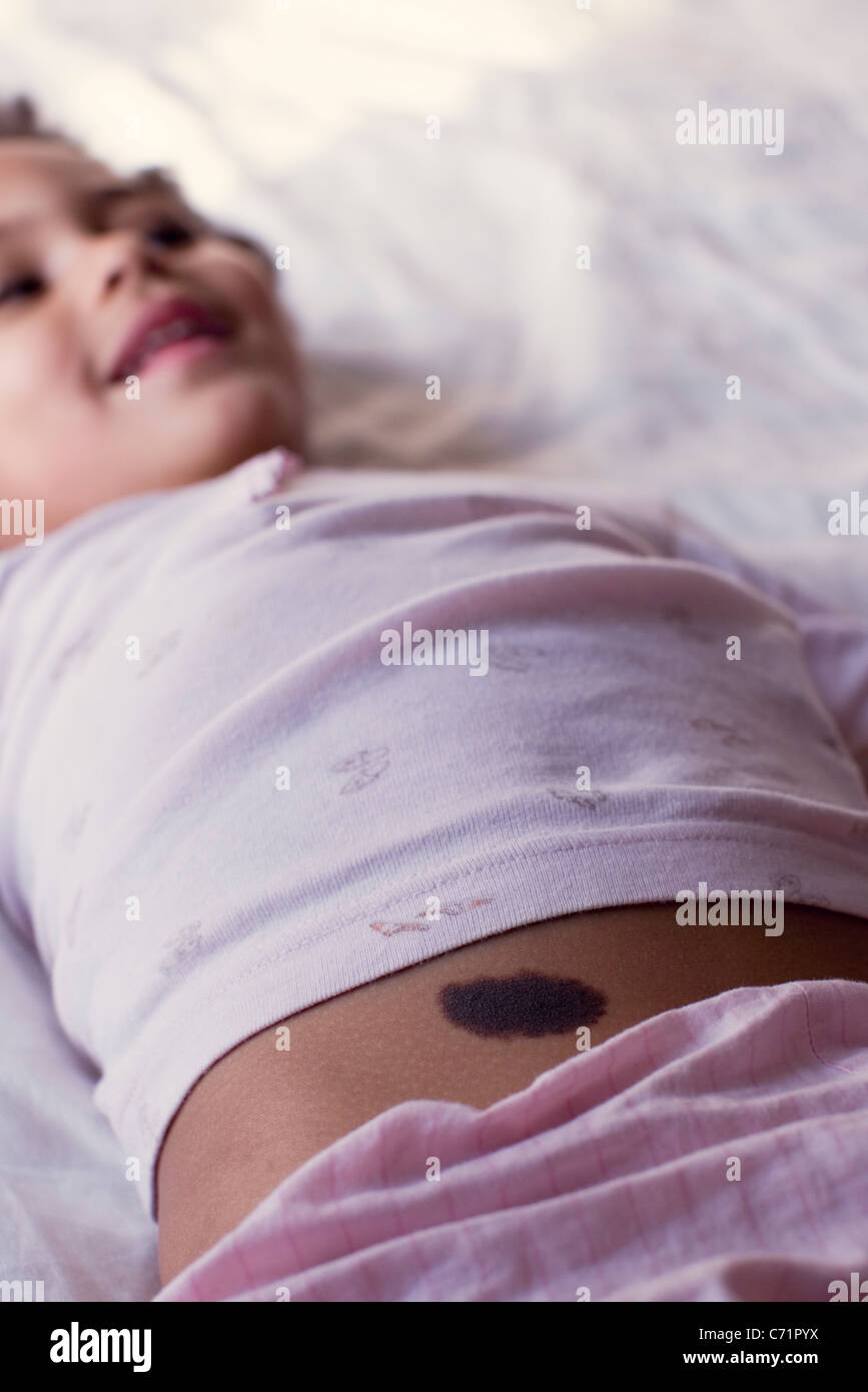 Birthmark hi-res stock photography and images - Alamy